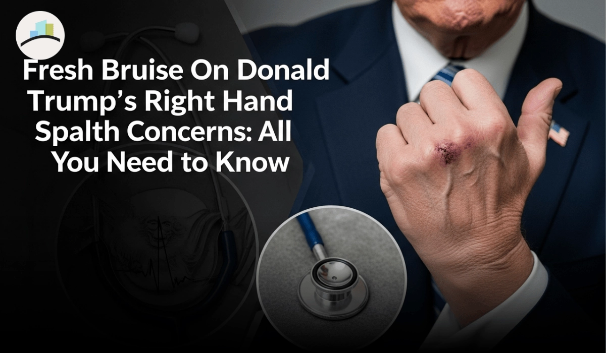 Fresh Bruise On Donald Trump's Right Hand Sparks Health Concerns: All ...
